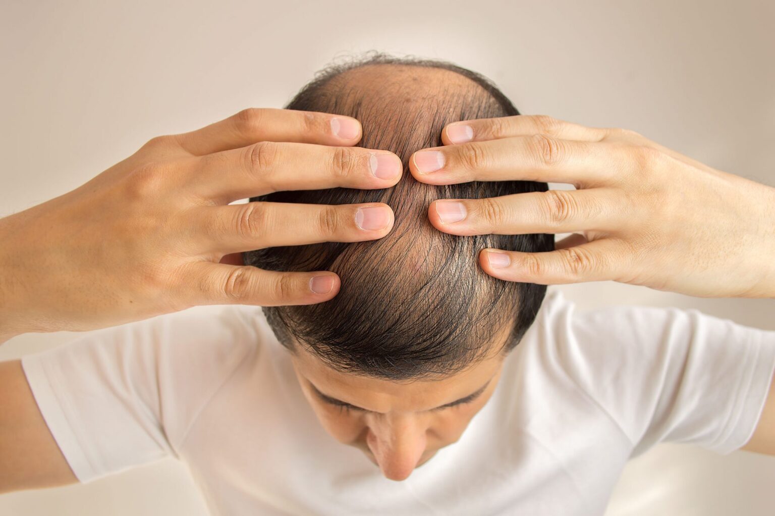 Early Signs of Balding in Men and Women